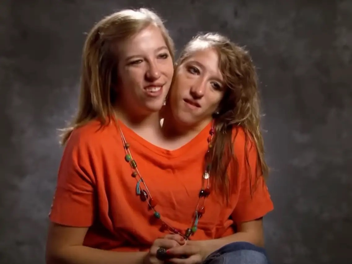 Conjoined twins Abby & Brittany's baby plans after secret wedding | New ...