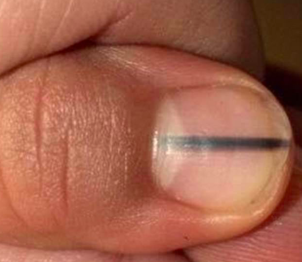 Beautician shares a photo of her clients nail as a warning of cancer ...