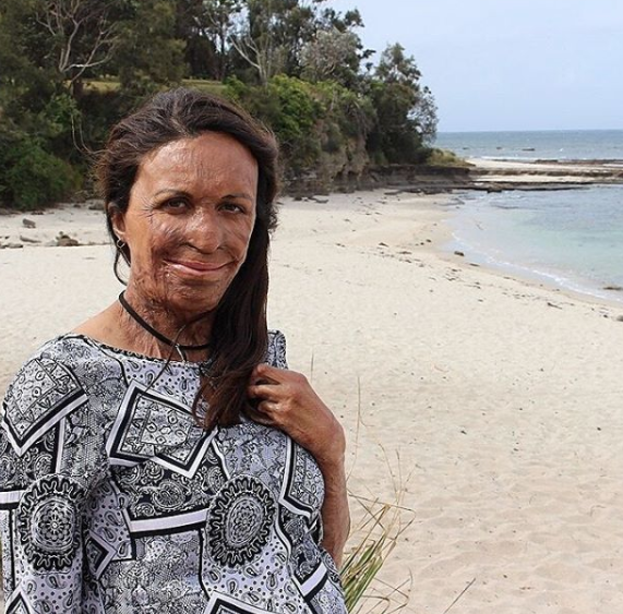 Burns survivor Turia Pitt says her baby boy is almost here | New Idea