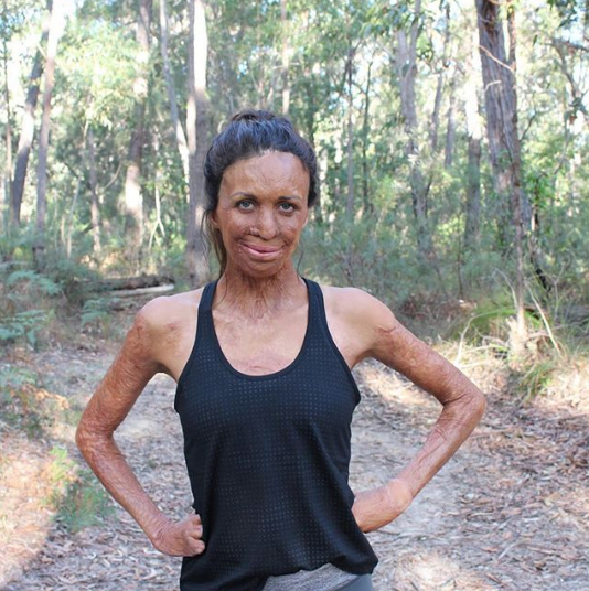 Turia Pitt undergoes surgery | New Idea