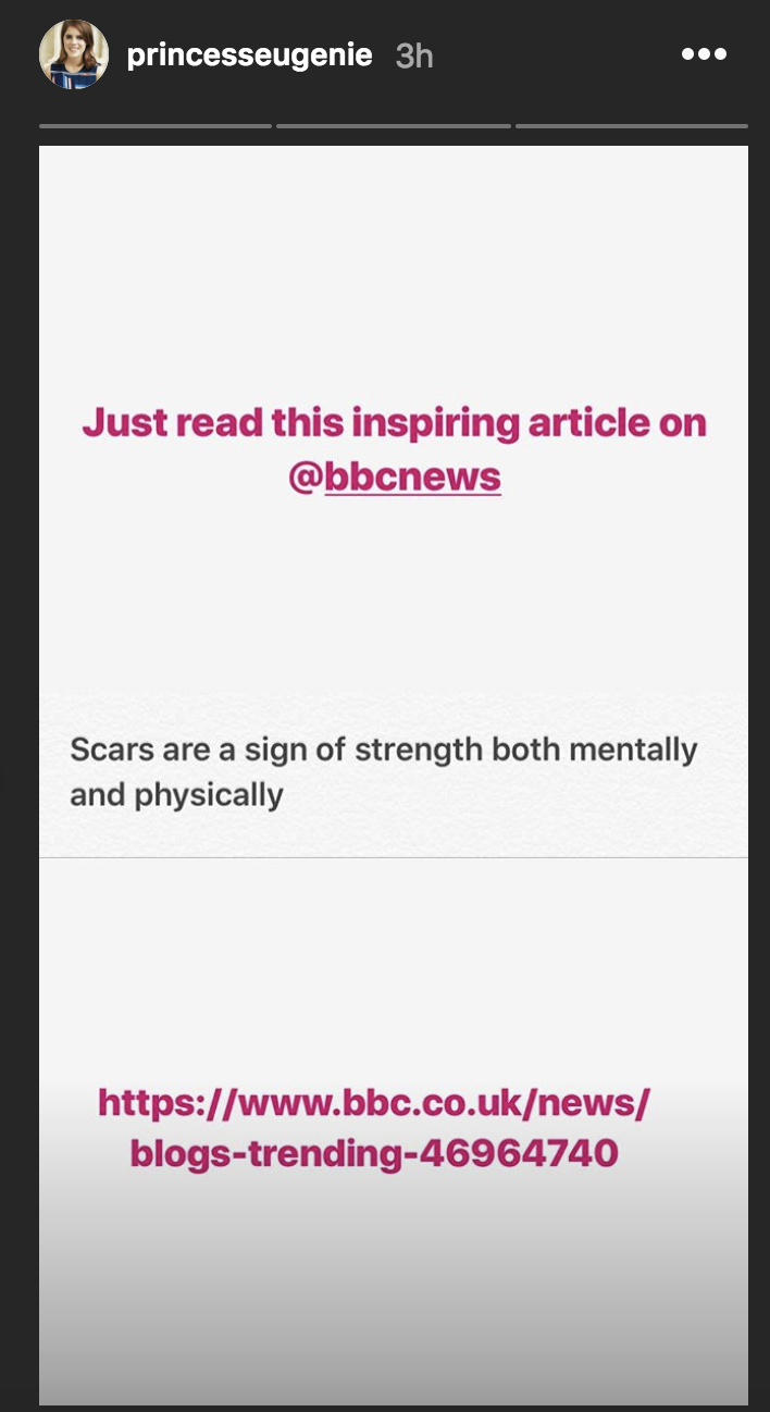 Princess Eugenie shares poignant message to 12-year-old girl with scar ...