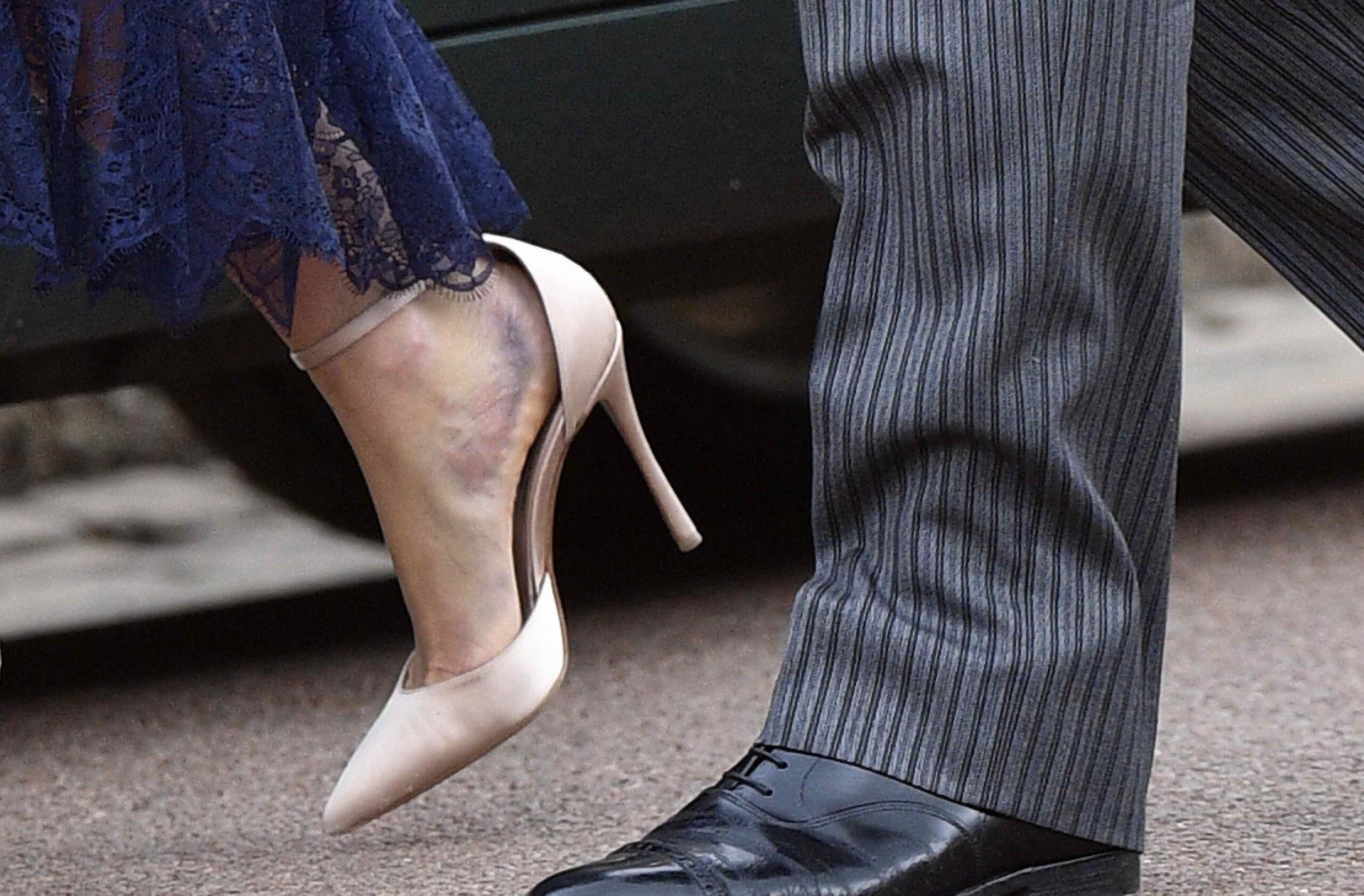 SHOCK PICS: Princess Beatrice in horror injury | New Idea